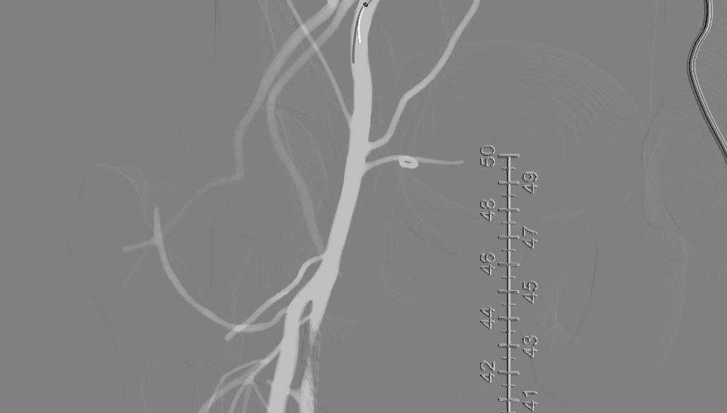 SFA Intervention Module - Surgical Science