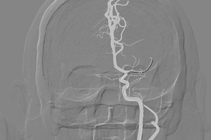 Acute Ischemic Stroke Module - Surgical Science