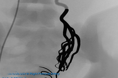 ANGIO Mentor - Surgical Science