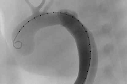 Advanced TEVAR Module - Surgical Science