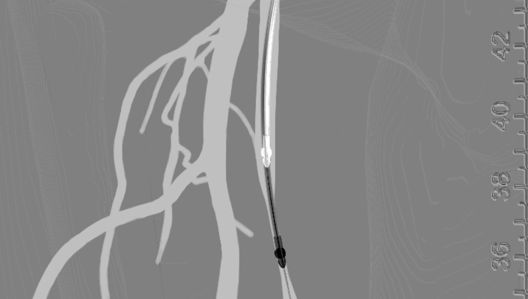 Atherectomy Module - Surgical Science