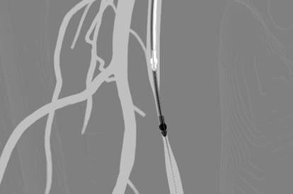 Atherectomy Module - Surgical Science