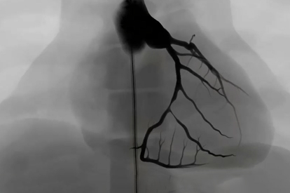 Coronary Bifurcation Module - Surgical Science