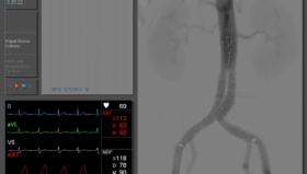 EVAR (Endovascular Aneurysm Repair) Module - Surgical Science