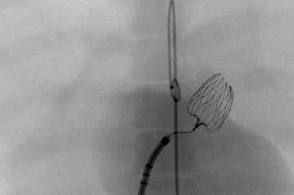 LAA Closure Module - Surgical Science