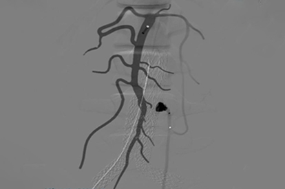 ANGIO Mentor - Surgical Science
