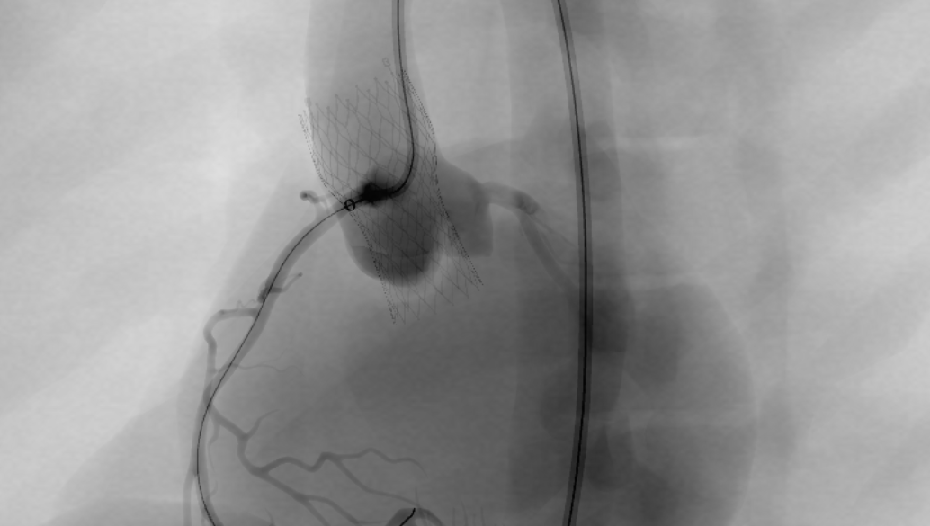 Coronary Intervention Module - Surgical Science