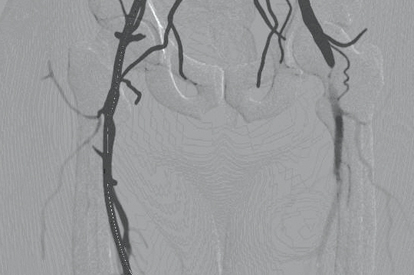 ANGIO Mentor - Surgical Science