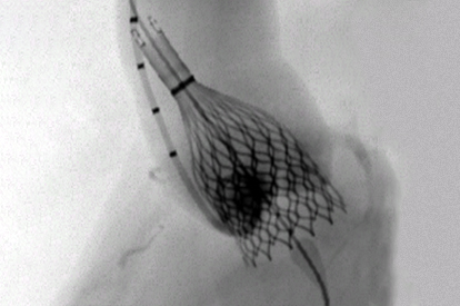 TAVI (Transcatheter Aortic Valve Implantation) Module