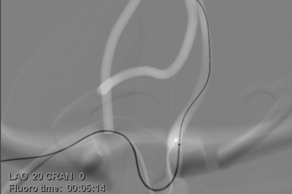 Transradial Cerebral Module - Surgical Science