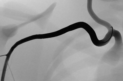 Transradial Coronary Intervention Module - Surgical Science