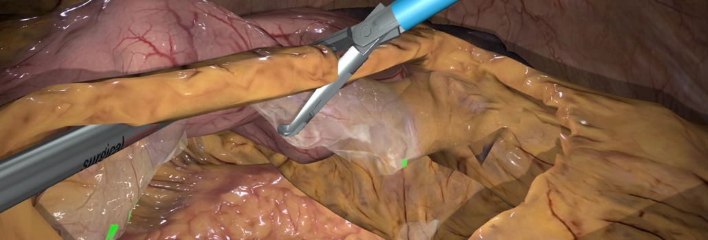 Distal Gastrectomy Module - Surgical Science