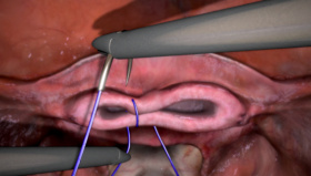 Vaginal Cuff Closure Module - Surgical Science