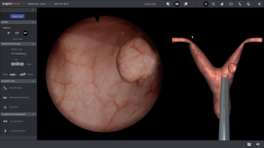 Hysteroscopic Polypectomy - Surgical Science