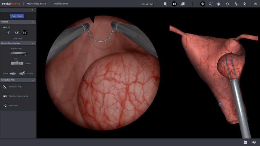 Hysteroscopic Myomectomy - Surgical Science