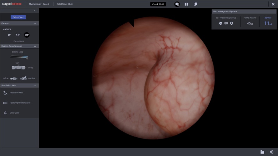 Hysteroscopic Myomectomy - Surgical Science