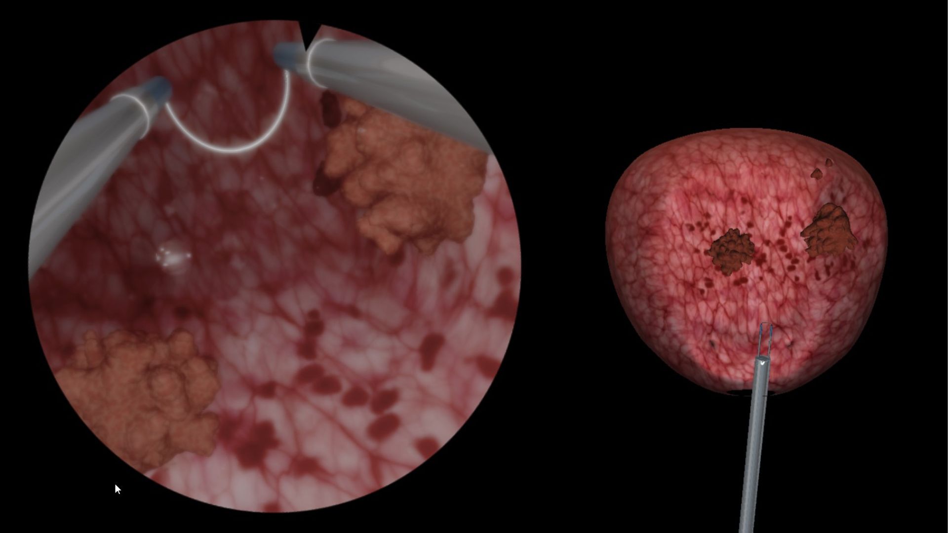 TURBT Module - Surgical Science