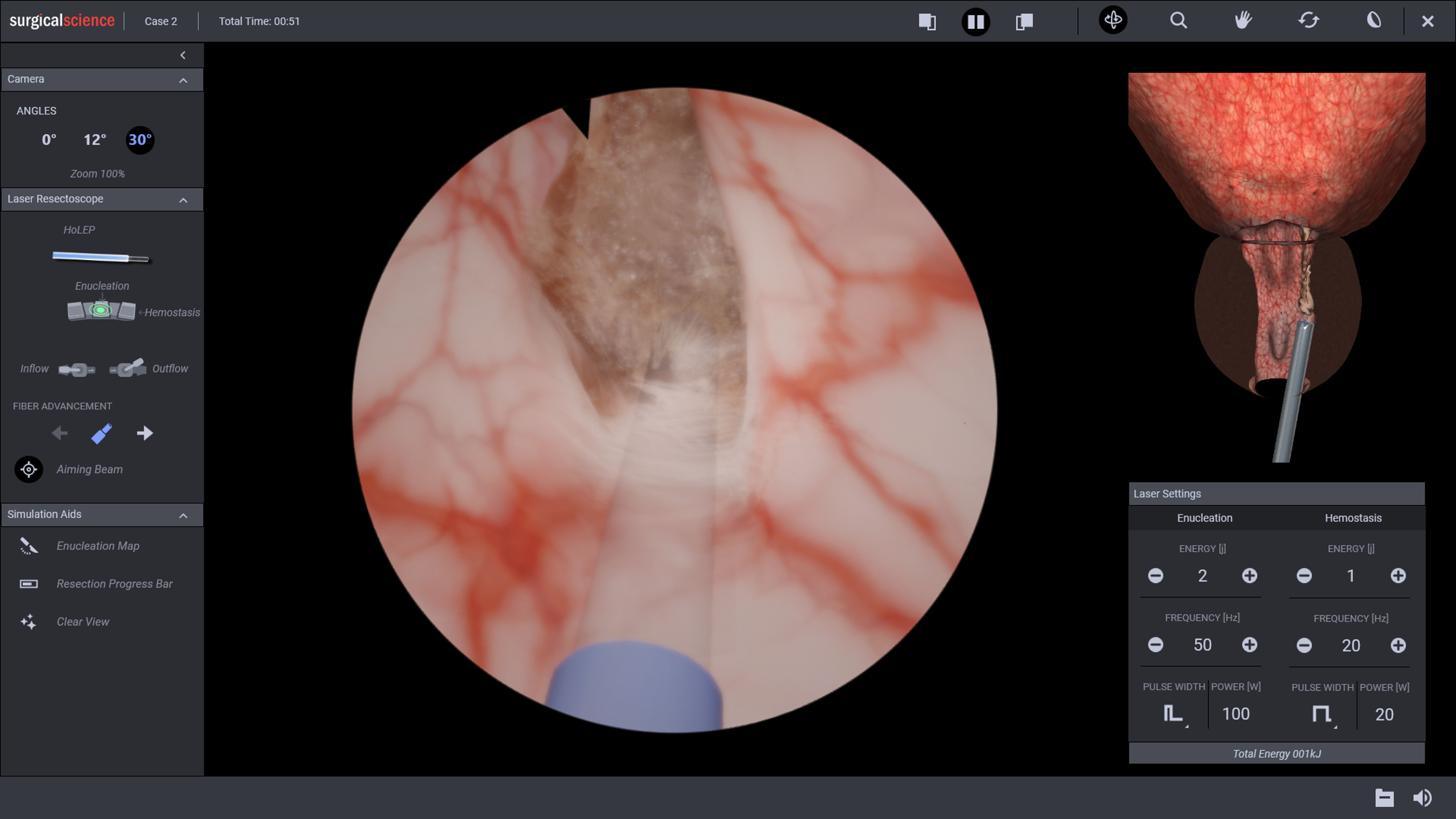 BPH Laser Treatments Module - Surgical Science